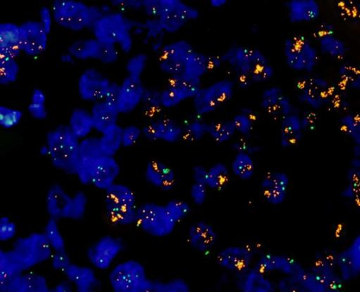 【新技术新项目】我院开展HER-2基因FISH检测技术，为临床乳腺癌靶向药物治疗提供可靠依据